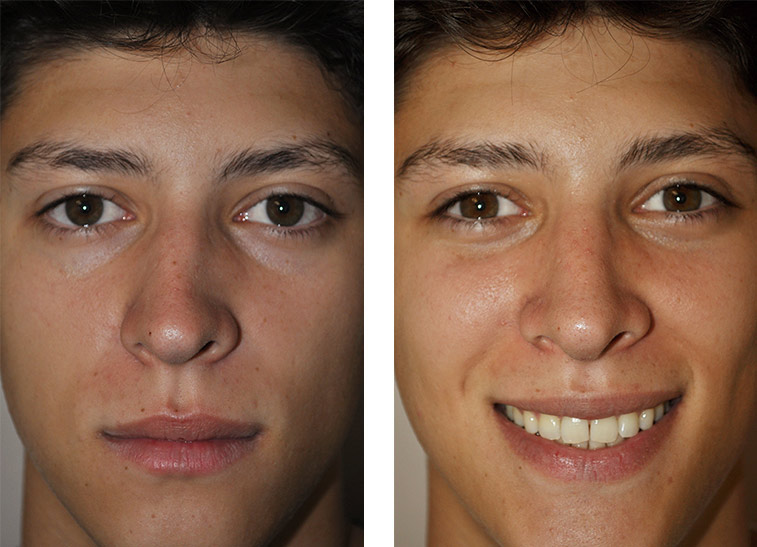Septoplasty Los Angeles Los Angeles Nose Surgery